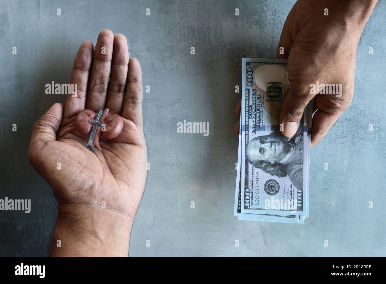 Buying and selling human kidney. Organ trafficking, organ transplant ...