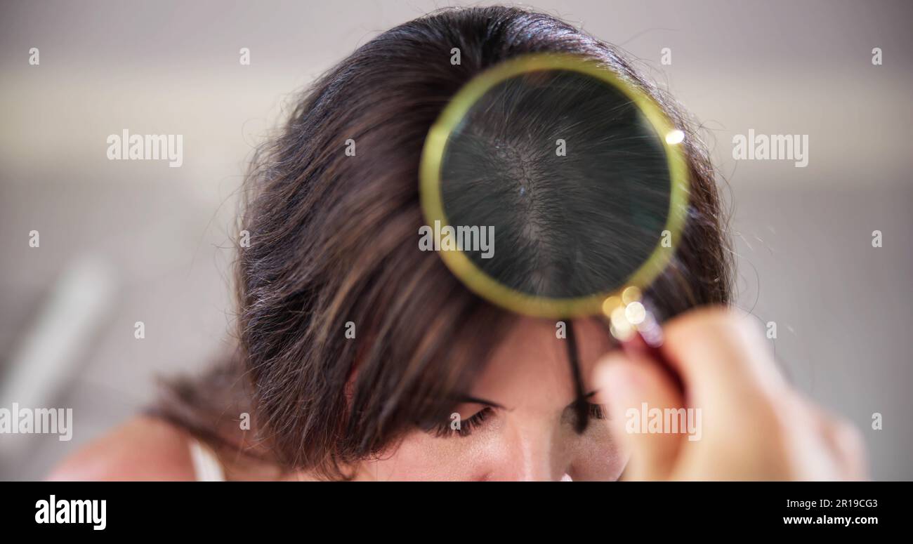 Hair Dandruff And Itchy Scalp Problem Treatment Stock Photo - Alamy