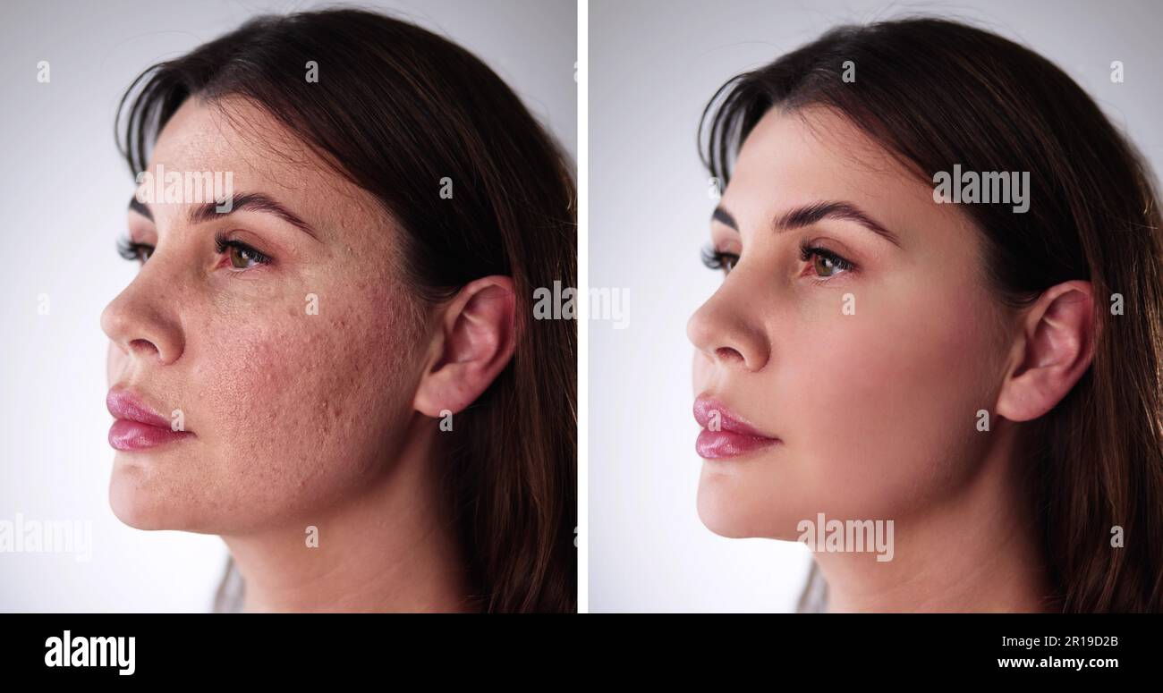Before After Young Girl Face Wrinkle Treatment Stock Photo - Alamy
