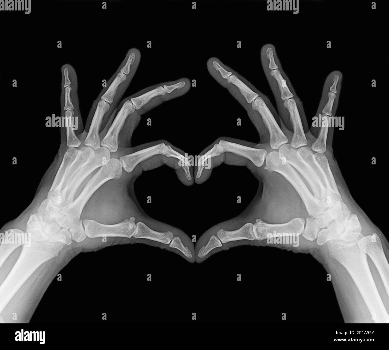 Oblique bilateral hand x-ray iwith the digits forming a heart shape ...