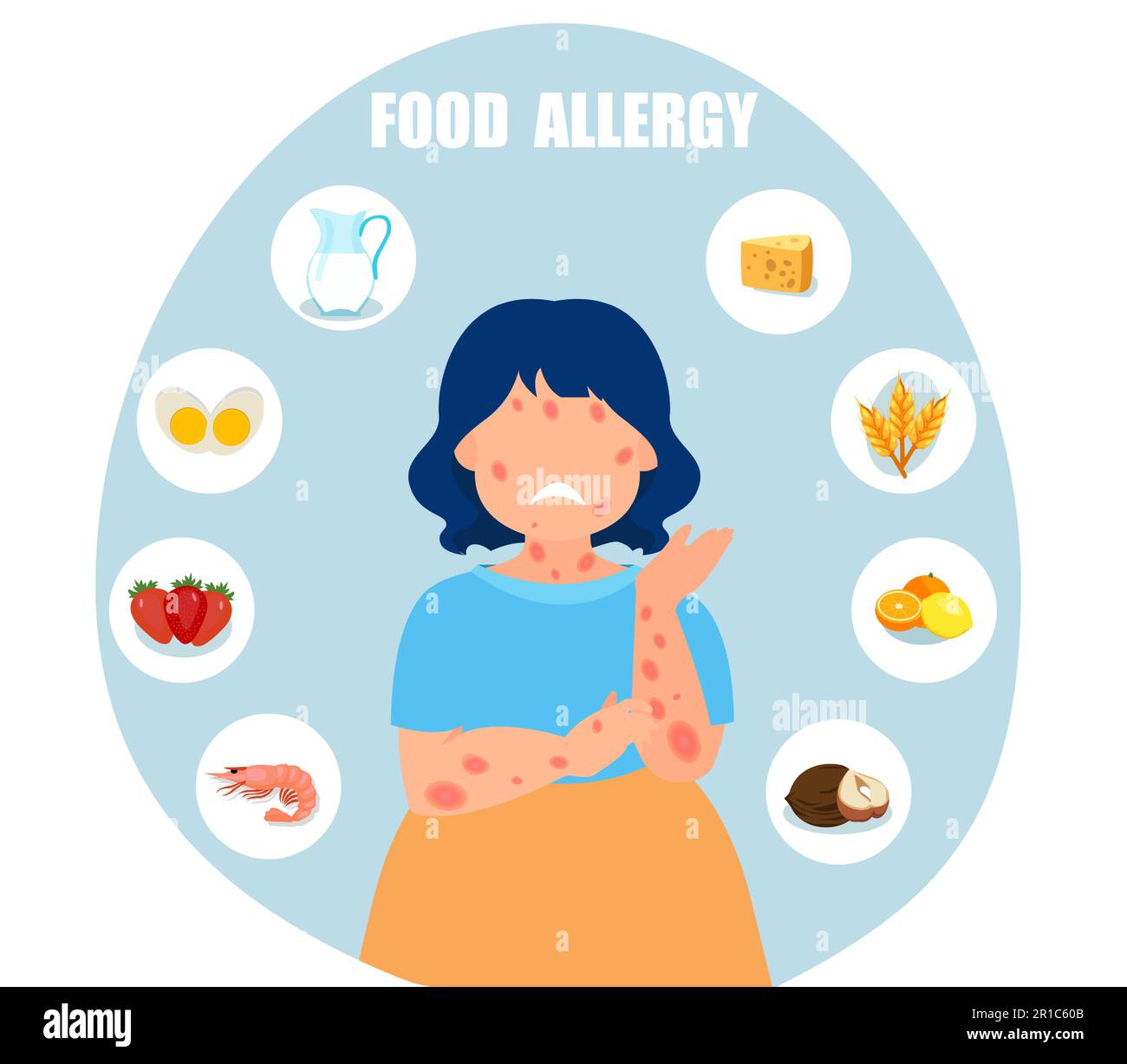 Vector of a child a girl with skin rash, food allergy Stock Vector ...