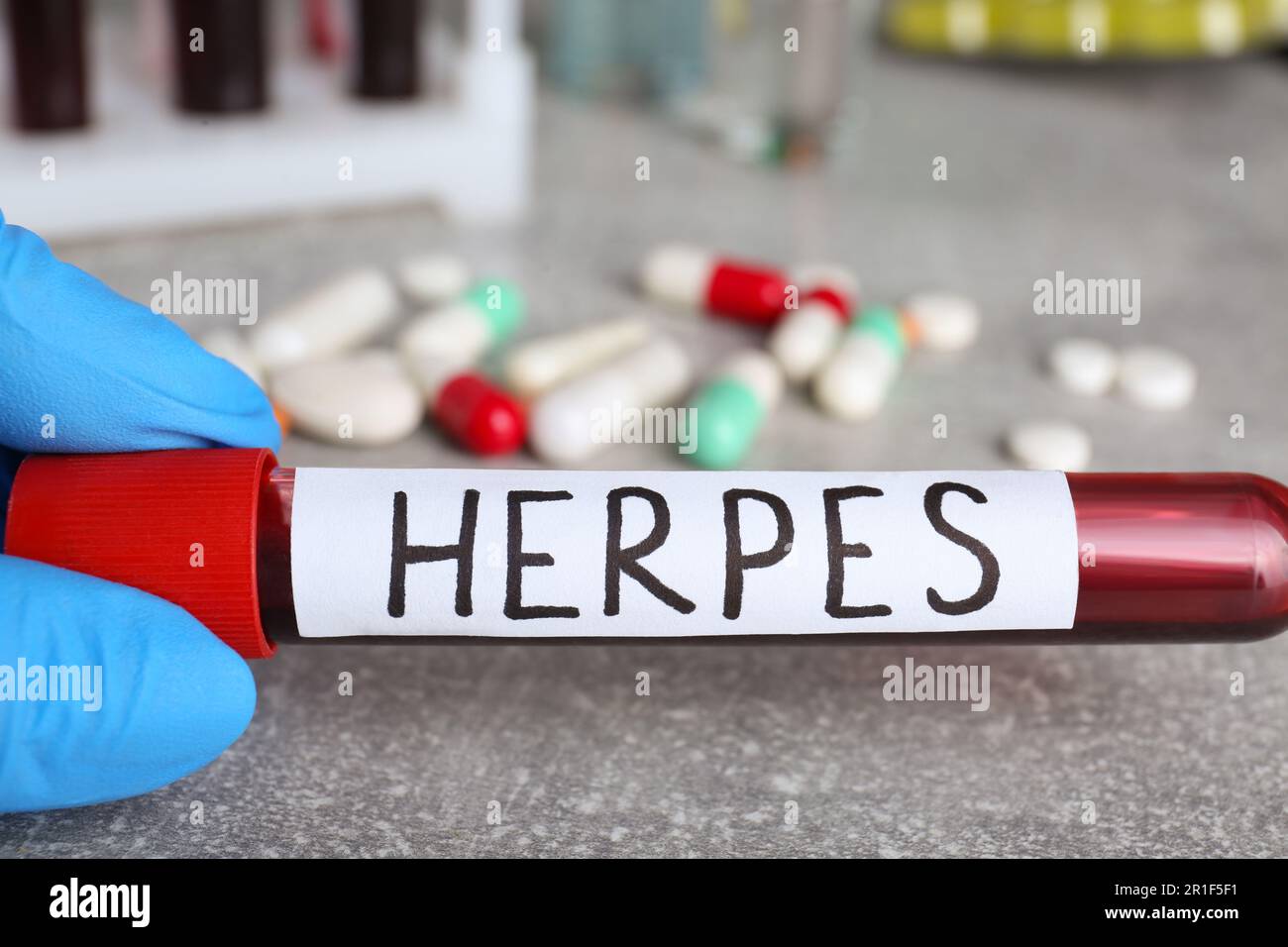 Doctor in glove holding test tube with word Herpes at light grey table ...