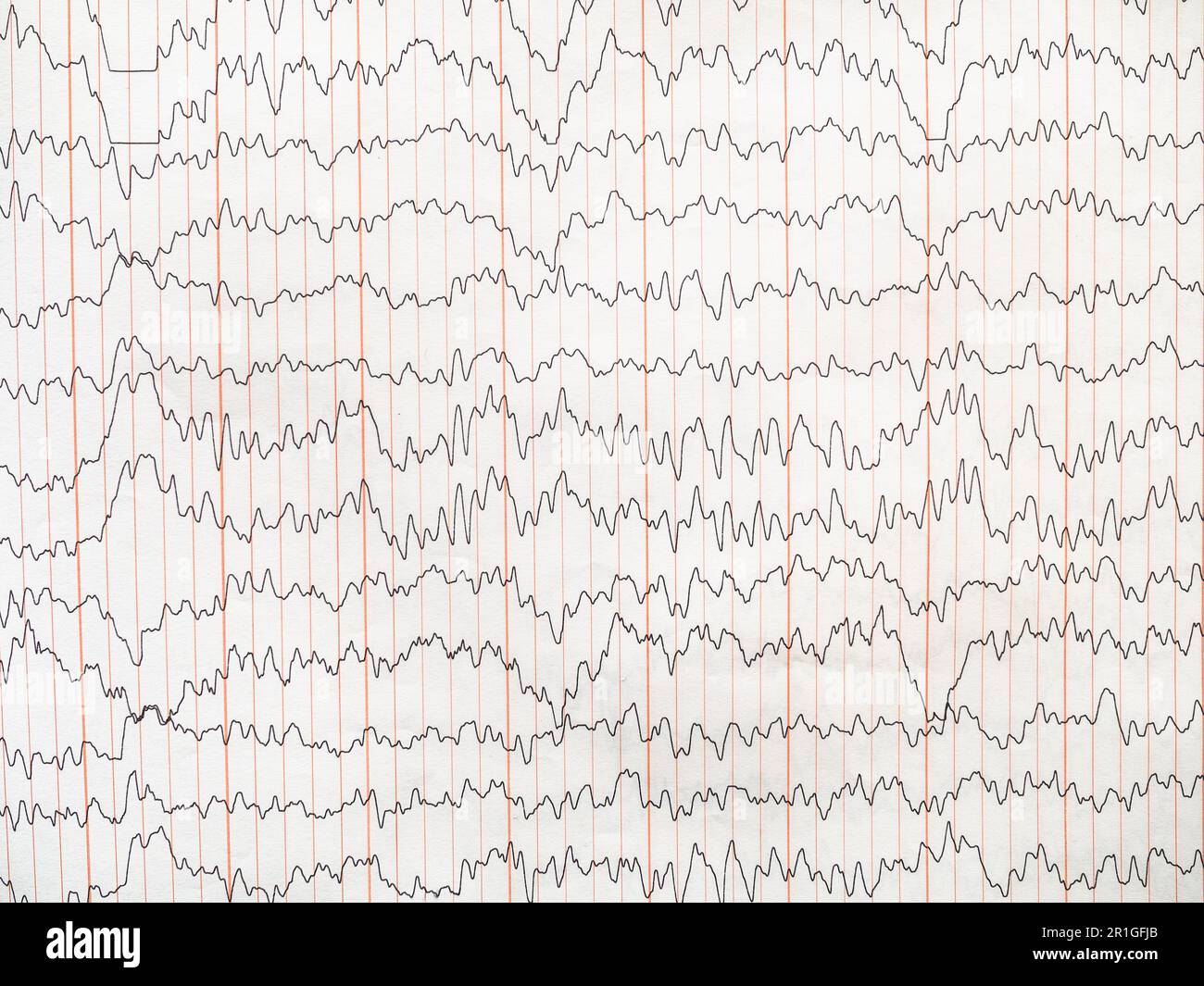 encephalogram on paper - amplitude-integrated electrical activity of ...
