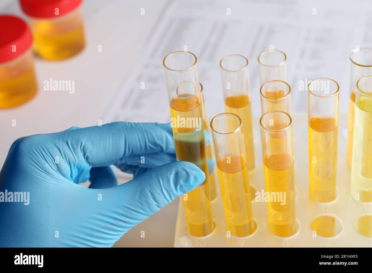 Nurse holding tube with urine sample for analysis at table, closeup ...