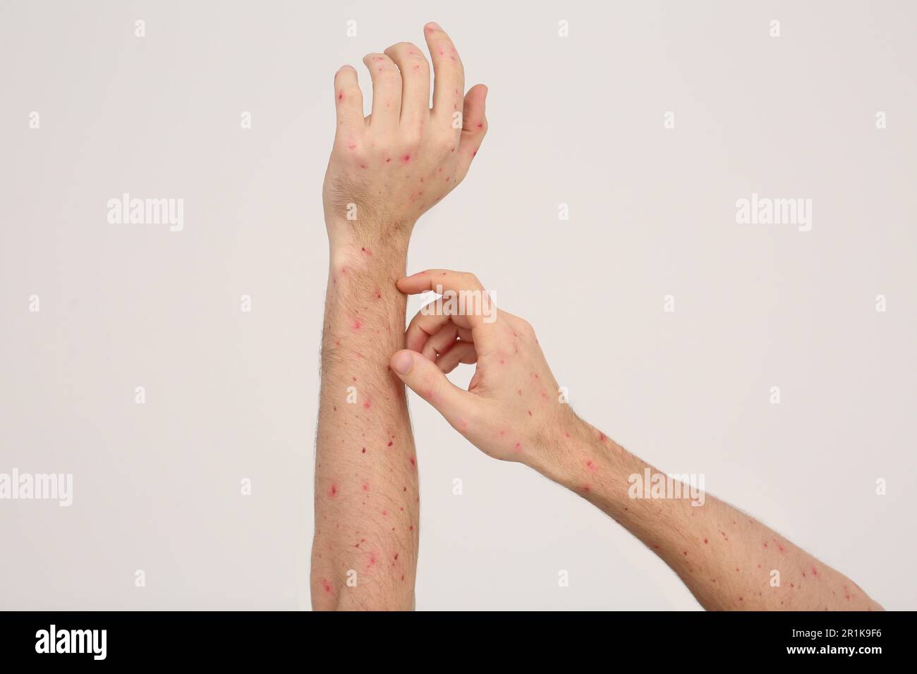 Man with rash suffering from monkeypox virus on beige background ...