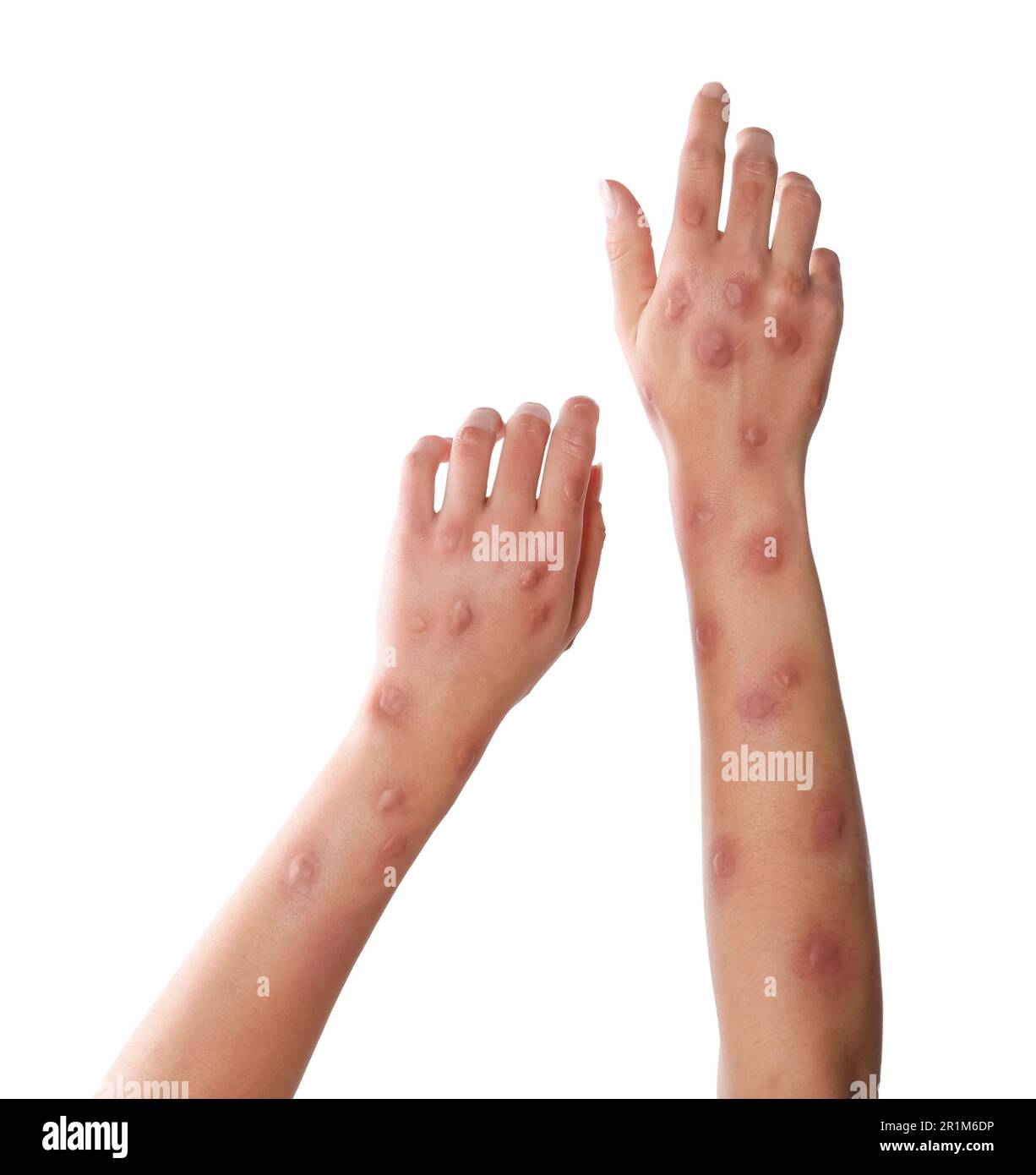 Itchy arms Cut Out Stock Images & Pictures - Alamy