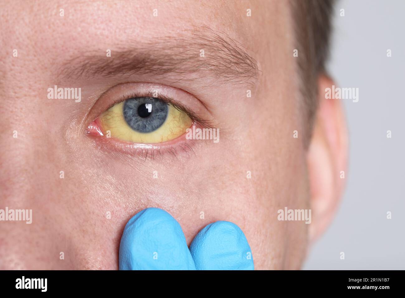 Doctor checking man with yellow eyes on light background, closeup ...
