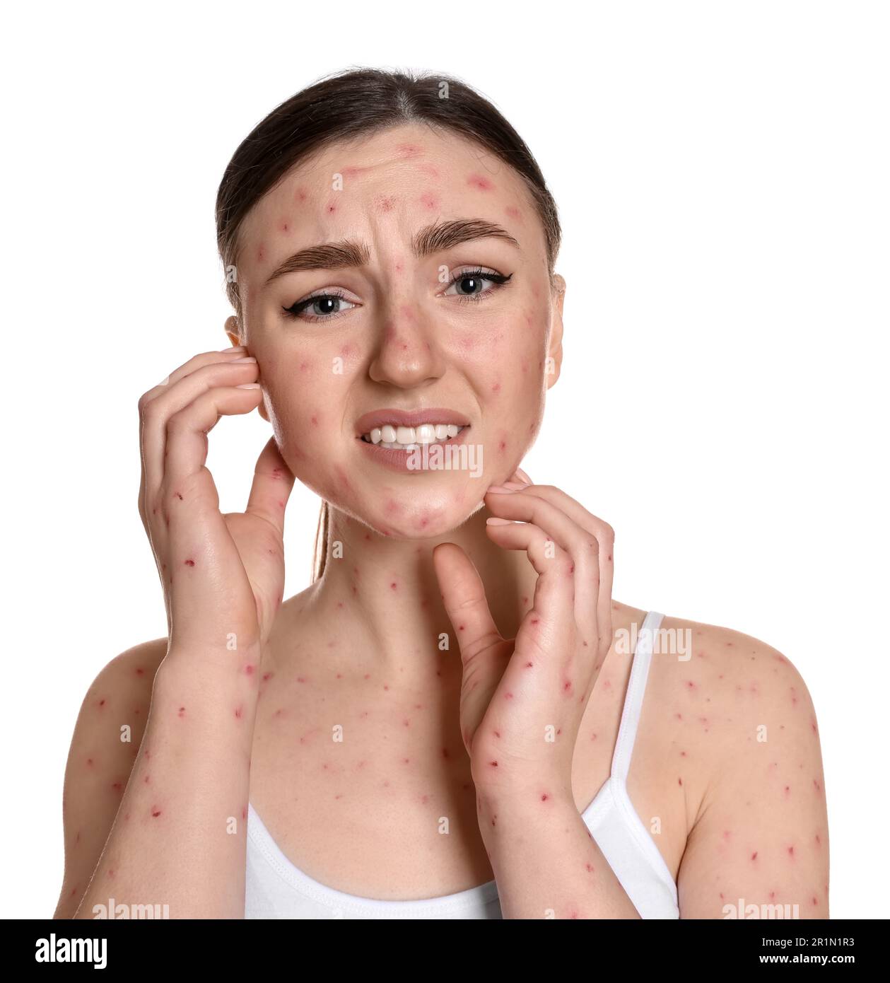 Woman with rash suffering from monkeypox virus on white background ...