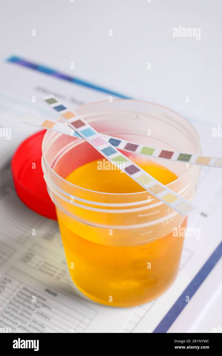 Container with urine sample for analysis and test strips on white table ...