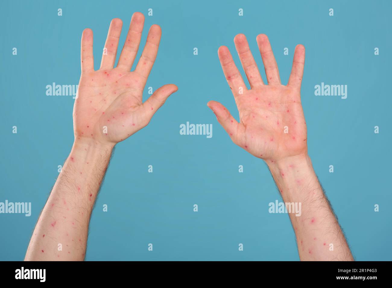 Sore spots hi-res stock photography and images - Alamy