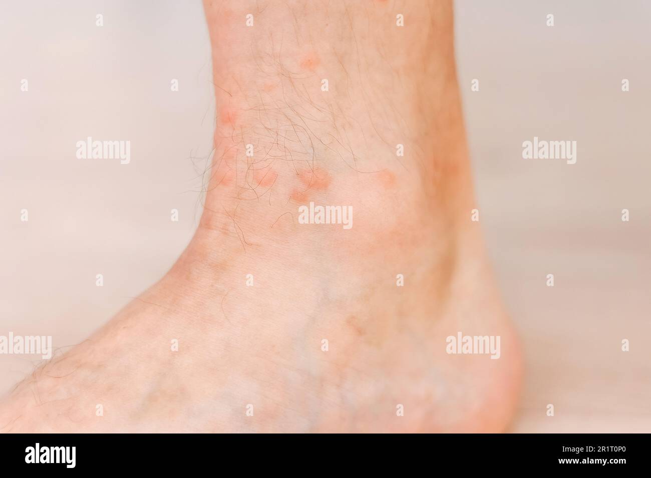 Close Up Allergic Rash Dermatitis Eczema On Man Foot Leg With Red Rash