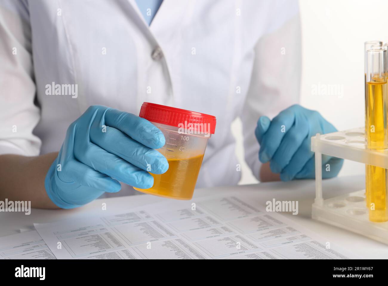 Nurse holding container with urine sample for analysis at table ...