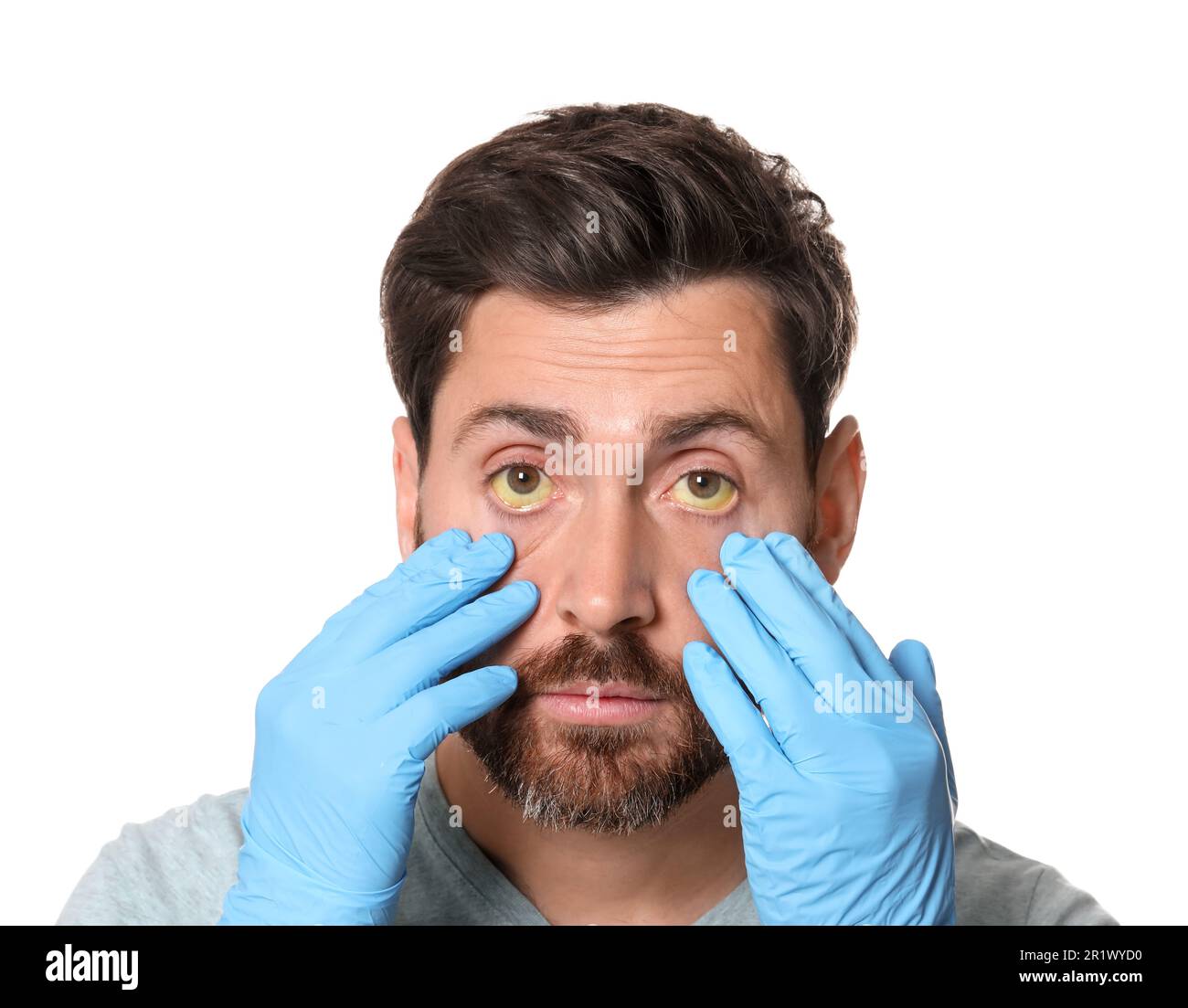 Doctor checking man with yellow eyes on white background. Symptom of ...