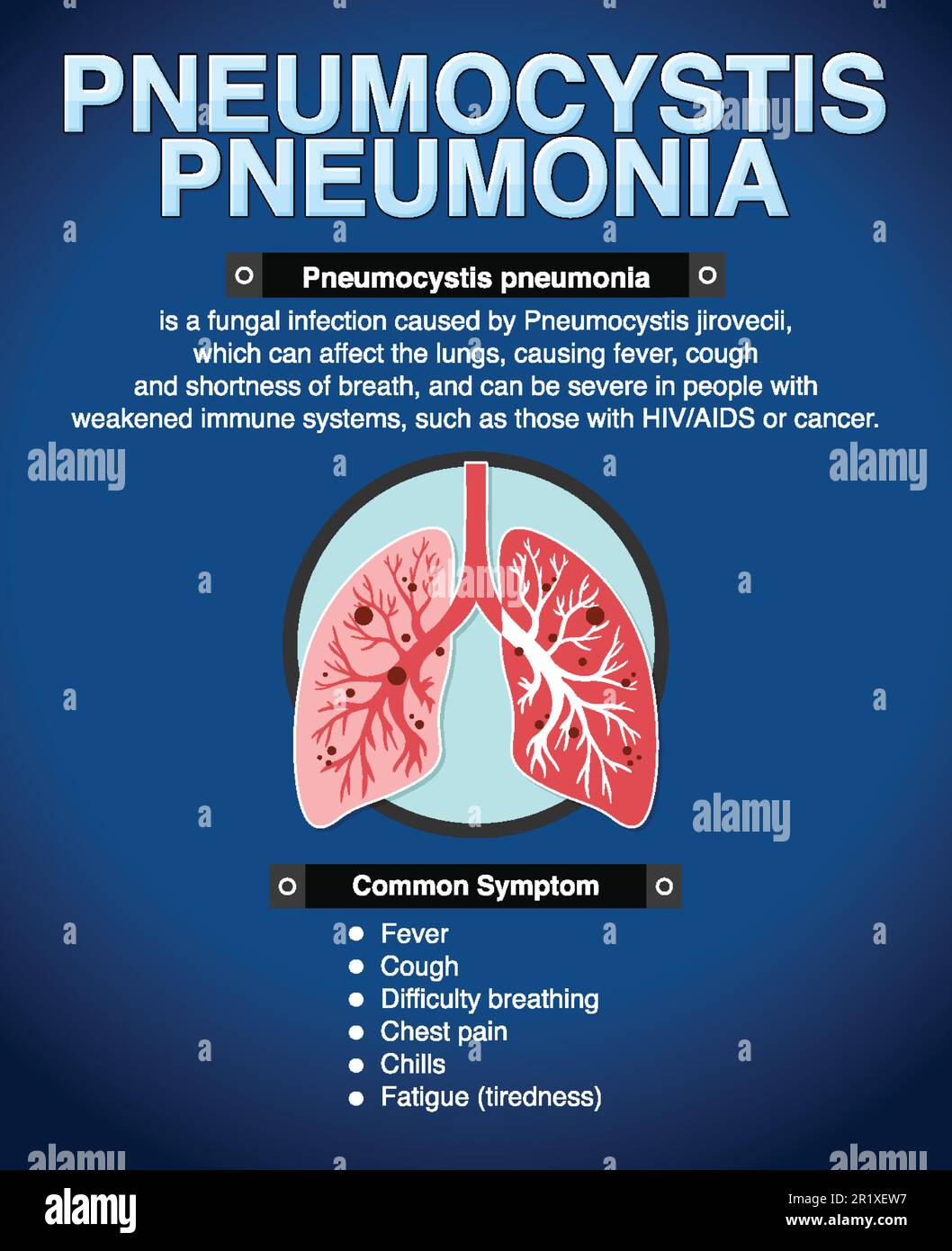 Informative poster of Pneumocystis Pneumonia illustration Stock Vector ...