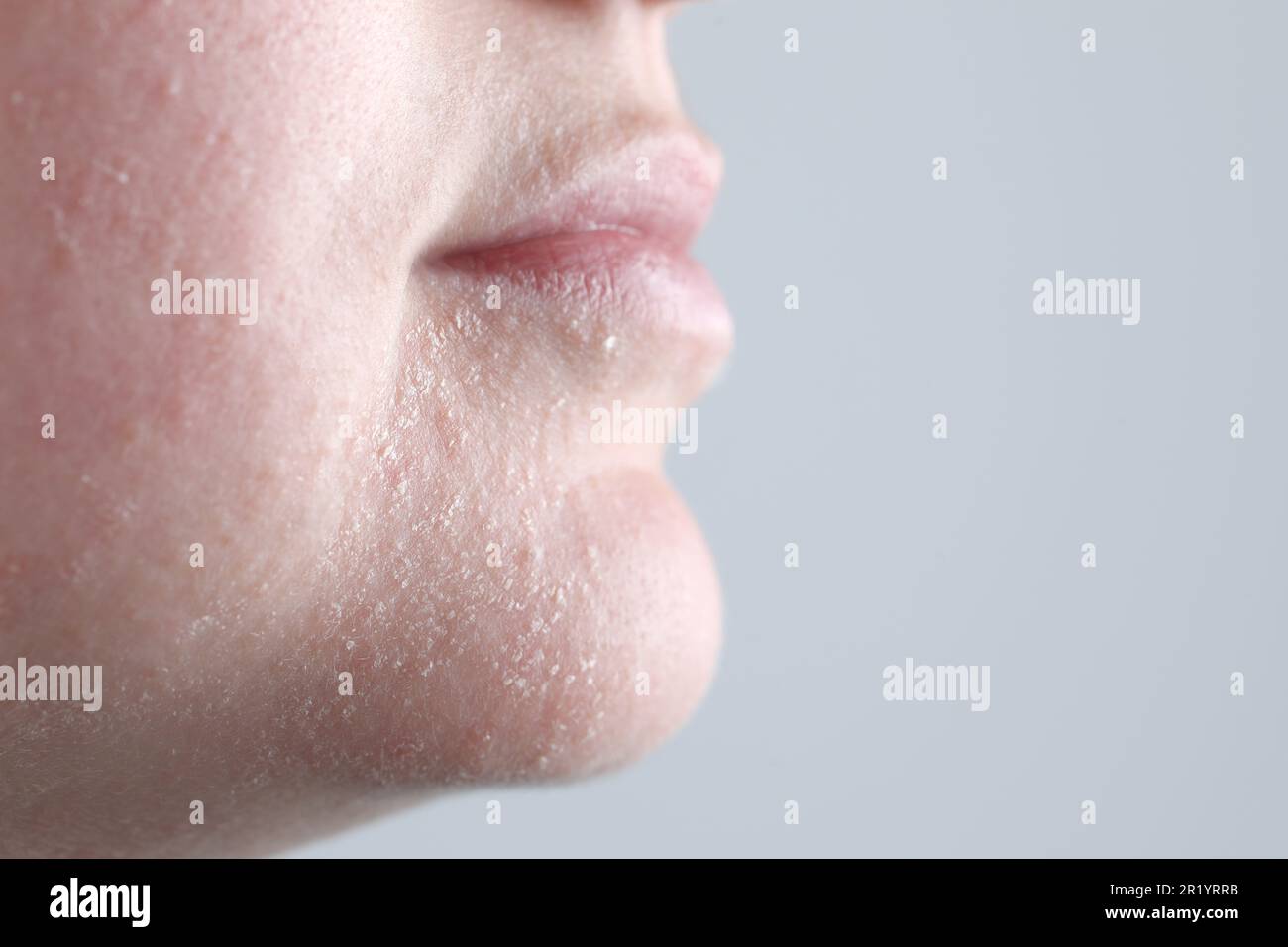 Woman with dry skin on face against light grey background, closeup ...