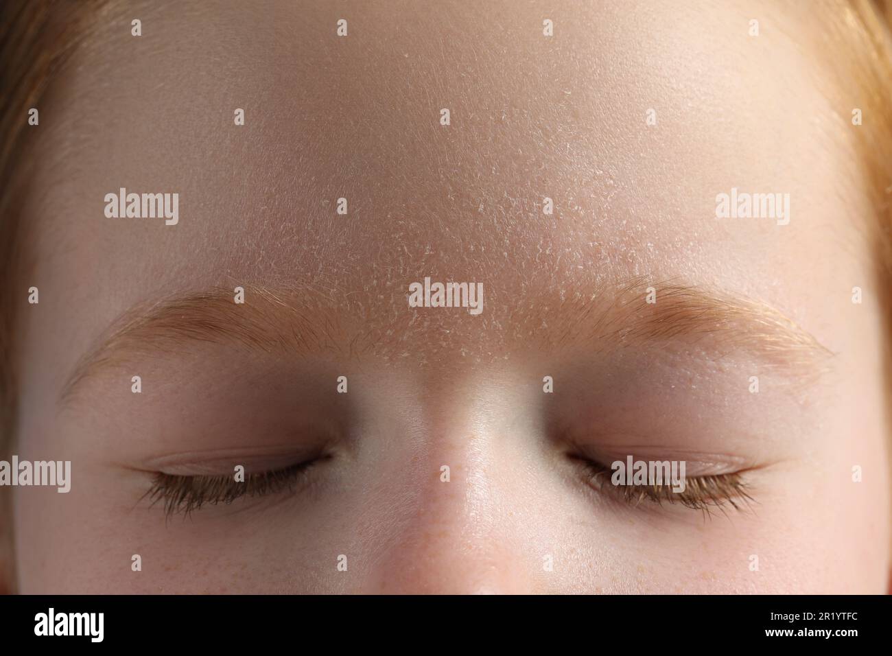 Little boy with dry skin on face, closeup Stock Photo - Alamy