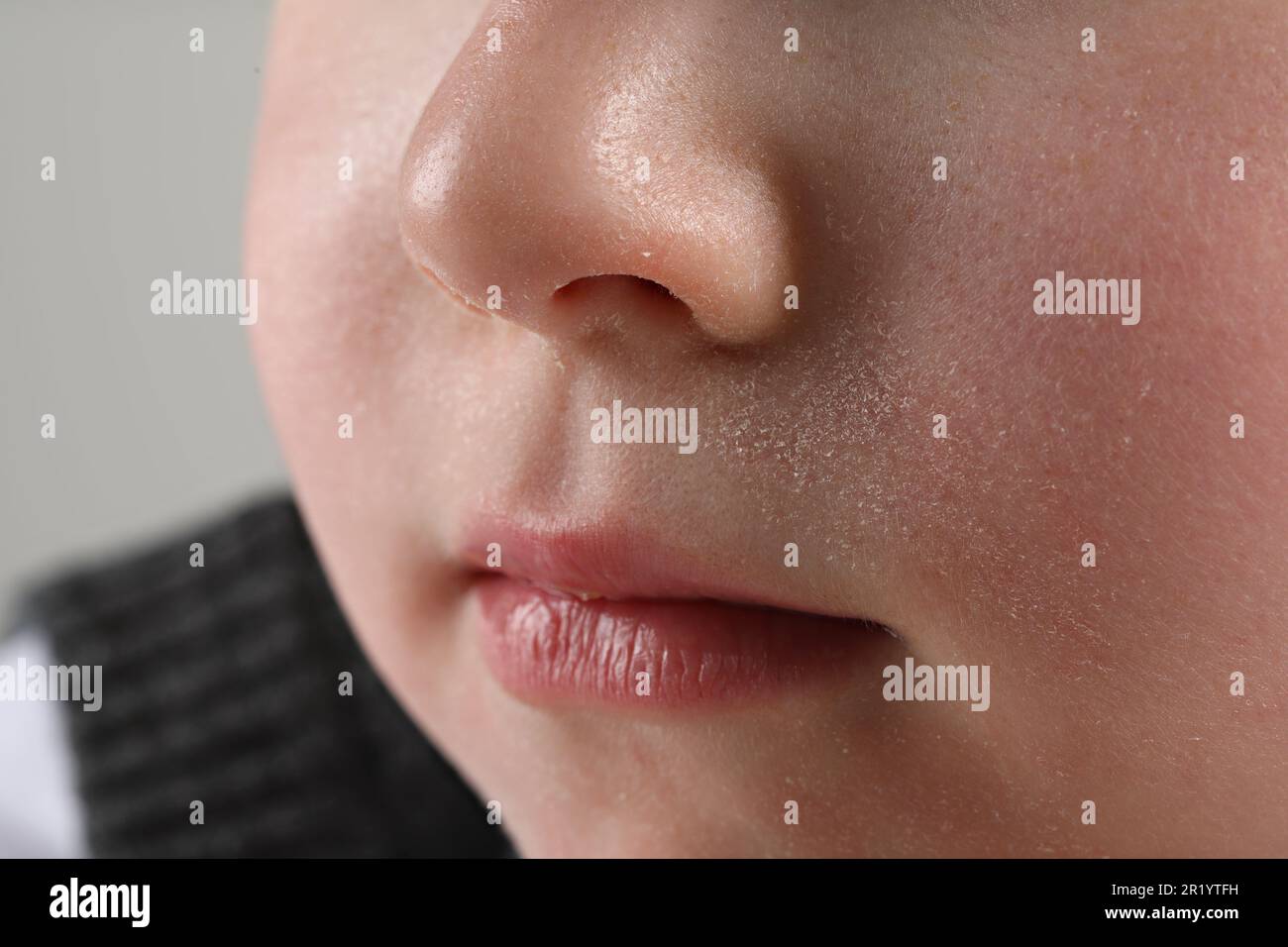 Little boy with dry skin on face, closeup Stock Photo - Alamy