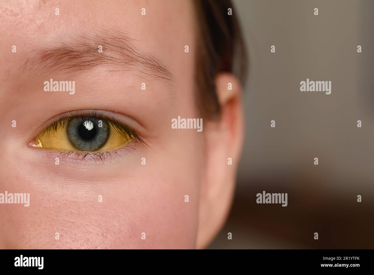 Woman with yellow eyes on blurred background, closeup. Symptom of ...