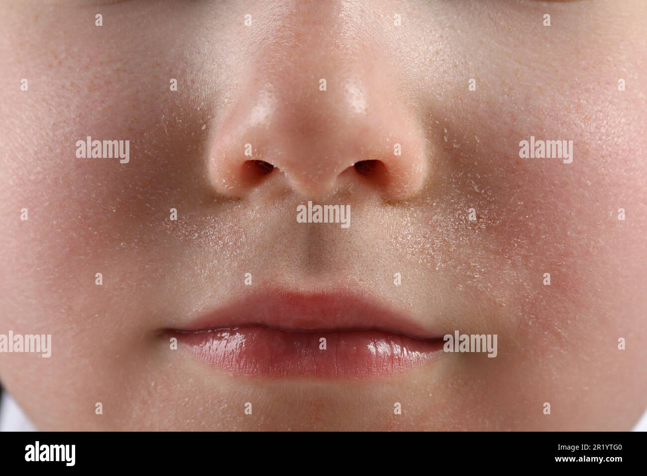 Little boy with dry skin on face, closeup Stock Photo - Alamy