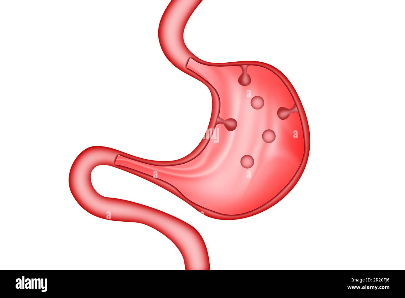 Stomach polyps of the digestive system, 3d rendering Stock Photo - Alamy