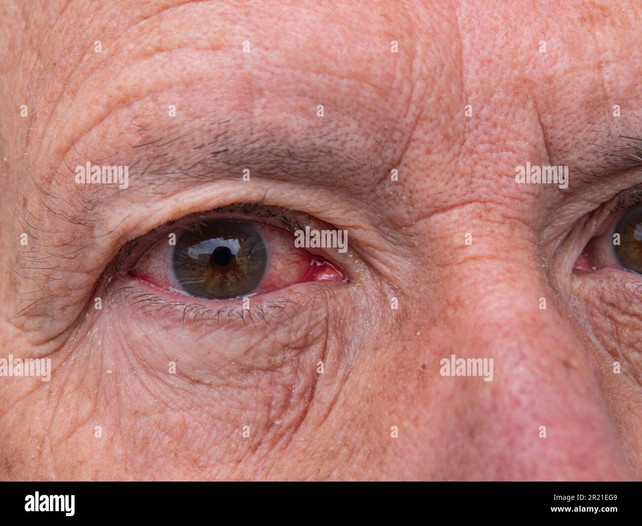 Closeup of irritated red bloodshot eye known as a hyphema ...