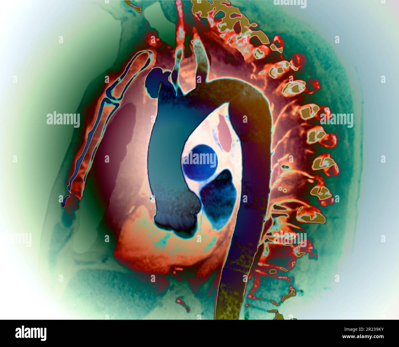 Aortic aneurysm, CT scan Stock Photo - Alamy
