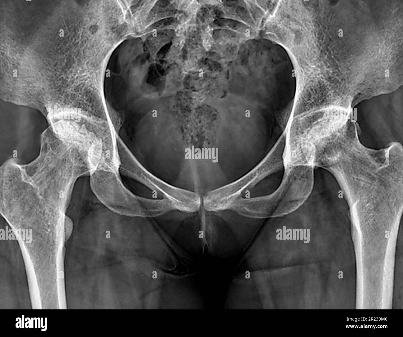 Hip disease, X-ray Stock Photo - Alamy