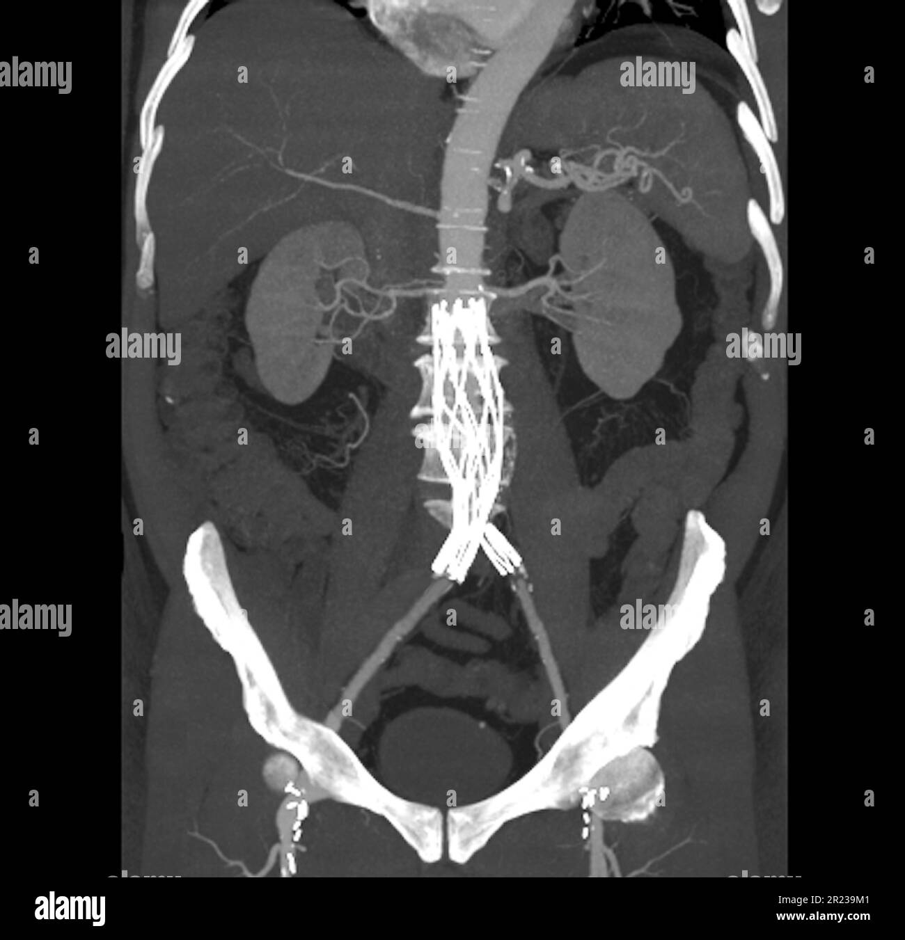 Aortic aneurysm stent, CT scan Stock Photo - Alamy