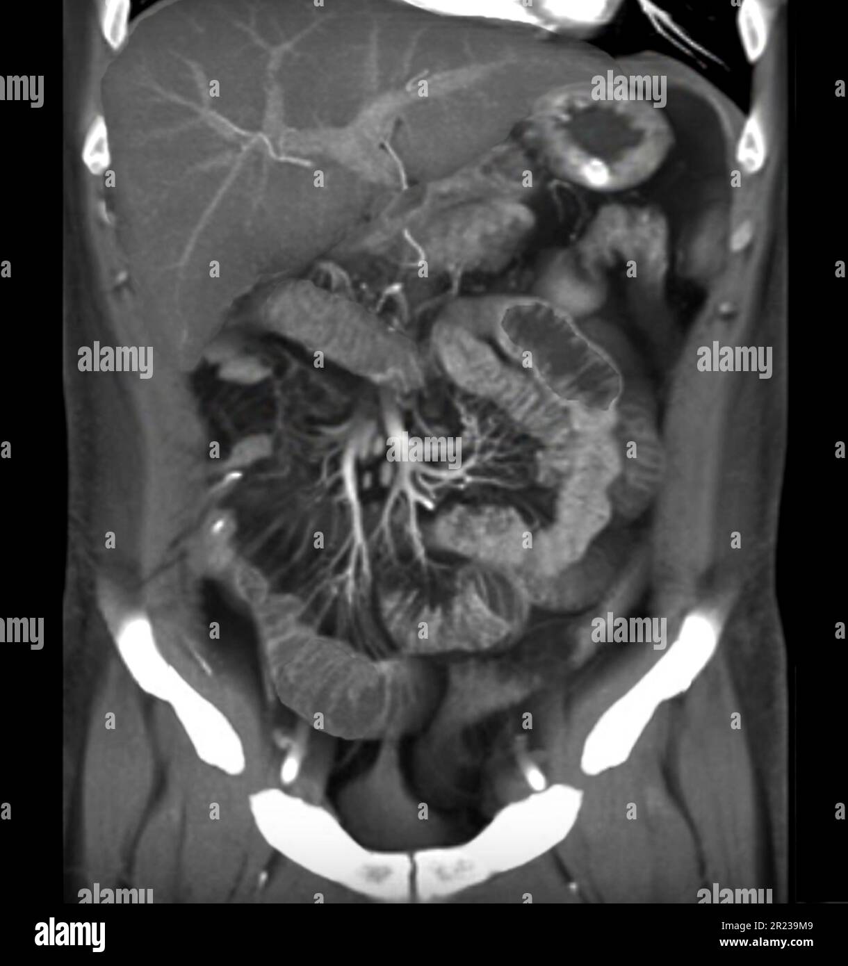 Abdomen, CT scan Stock Photo - Alamy