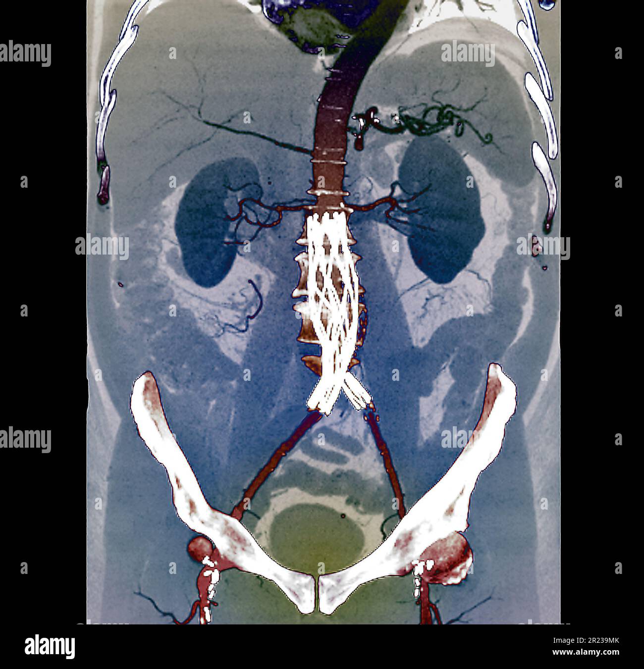 Aortic aneurysm stent, CT scan Stock Photo - Alamy