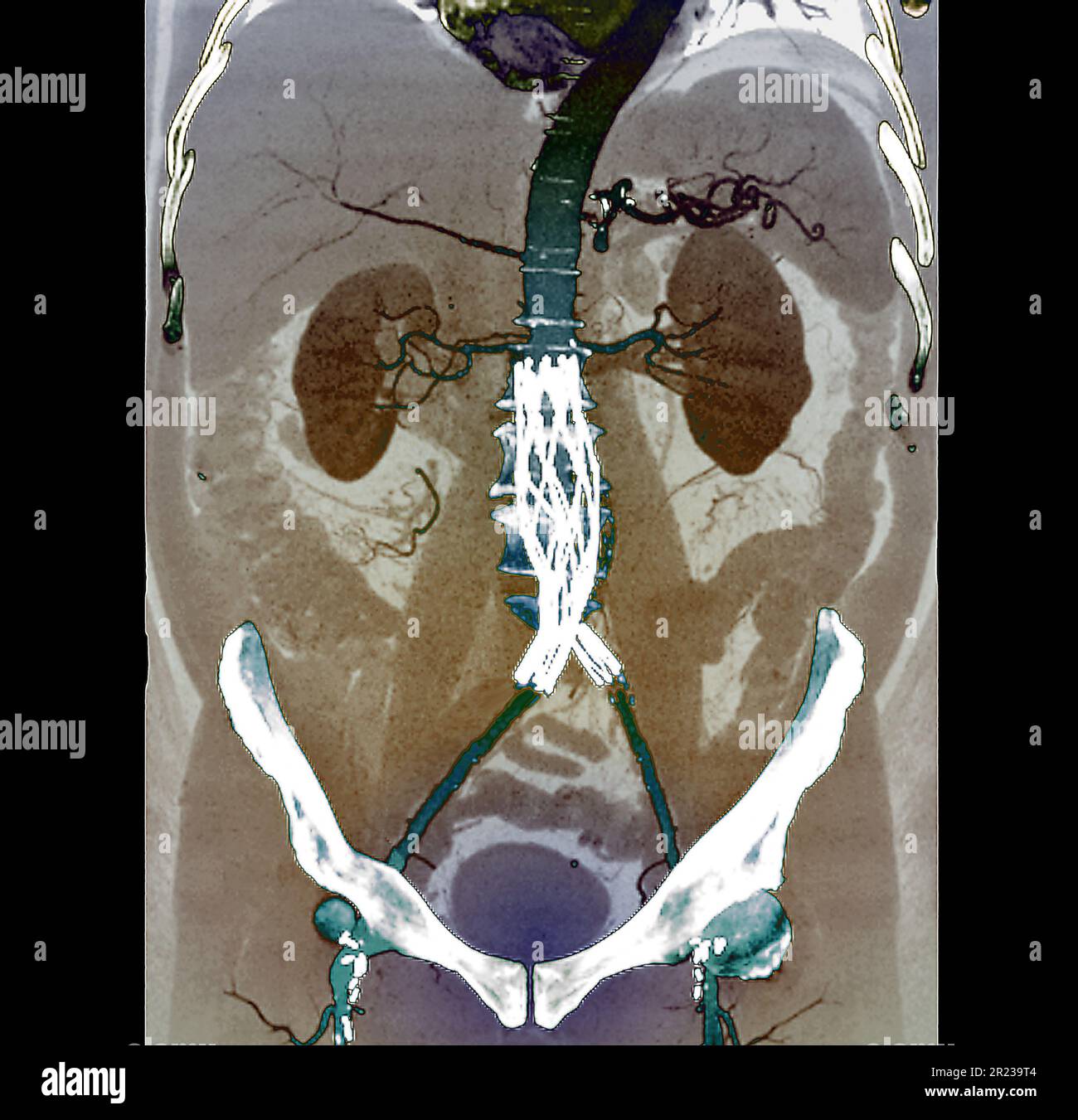 Aortic aneurysm stent, CT scan Stock Photo - Alamy