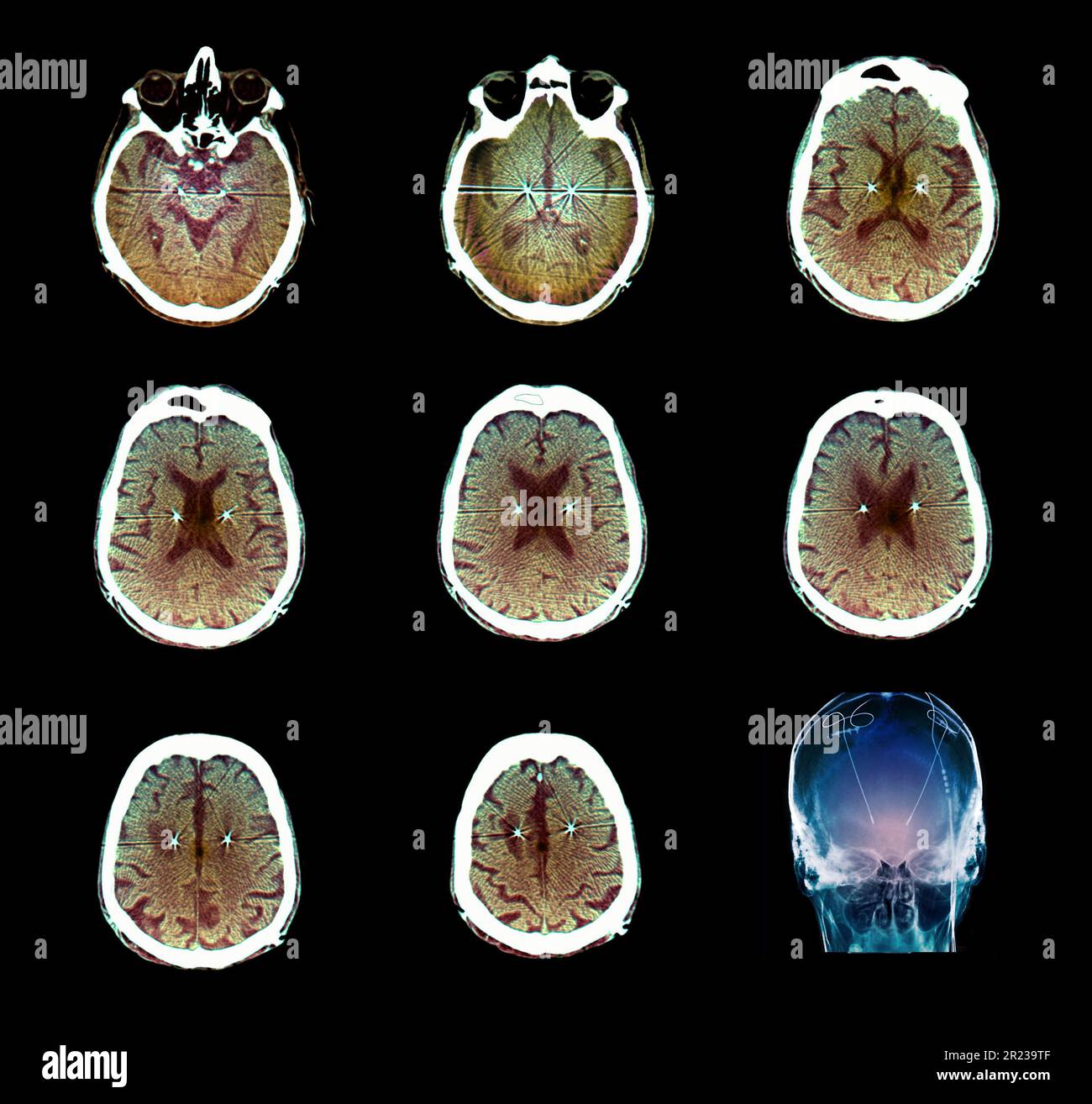Parkinson's disease electrode implants, CT scans Stock Photo - Alamy