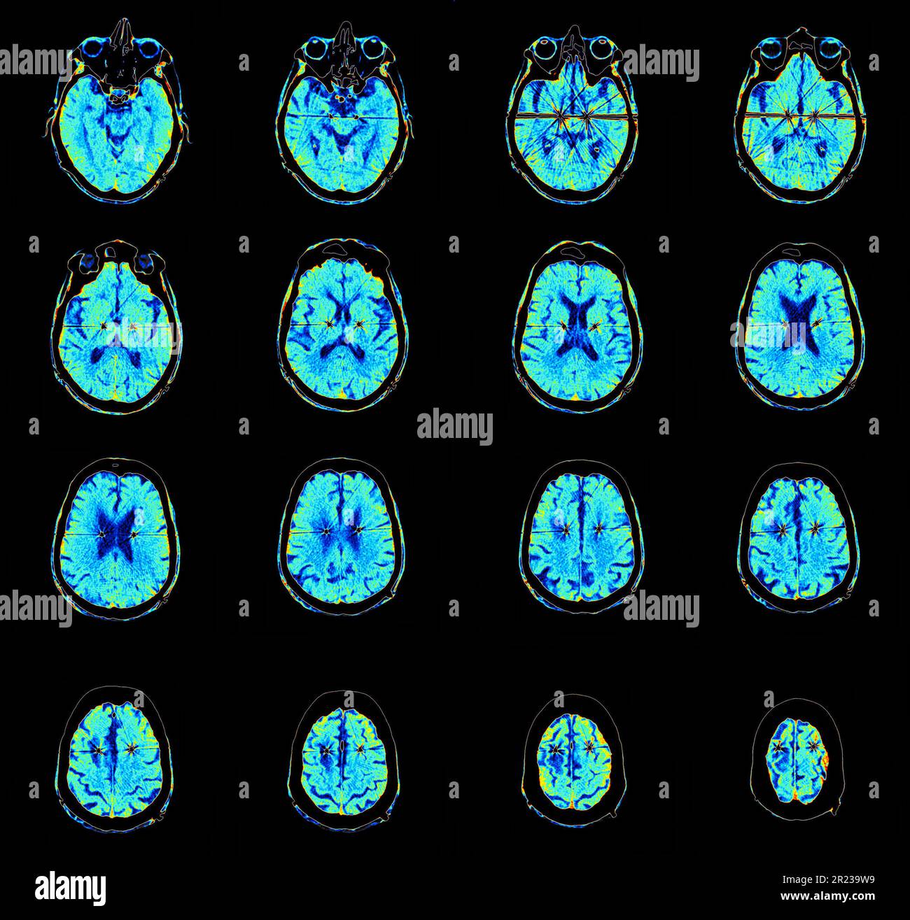 Parkinson's disease electrode implants, CT scans Stock Photo - Alamy