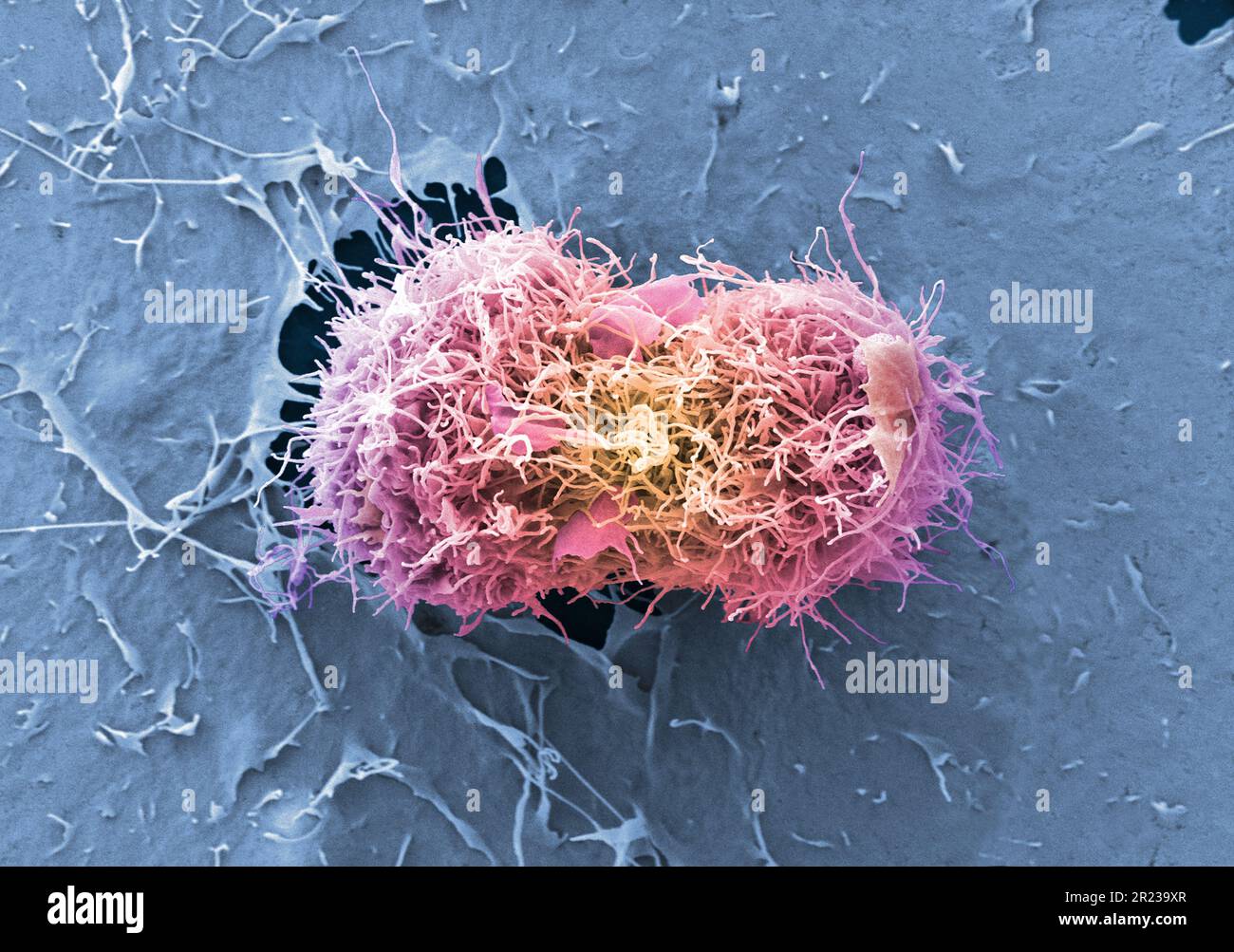 Cervical cancer cells dividing, SEM Stock Photo - Alamy