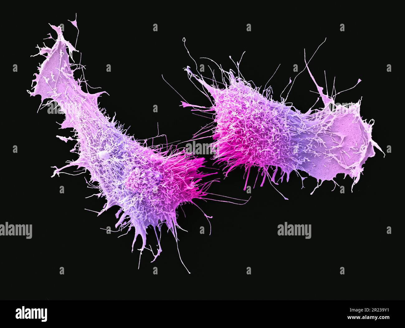 Cervical cancer cells, SEM Stock Photo - Alamy