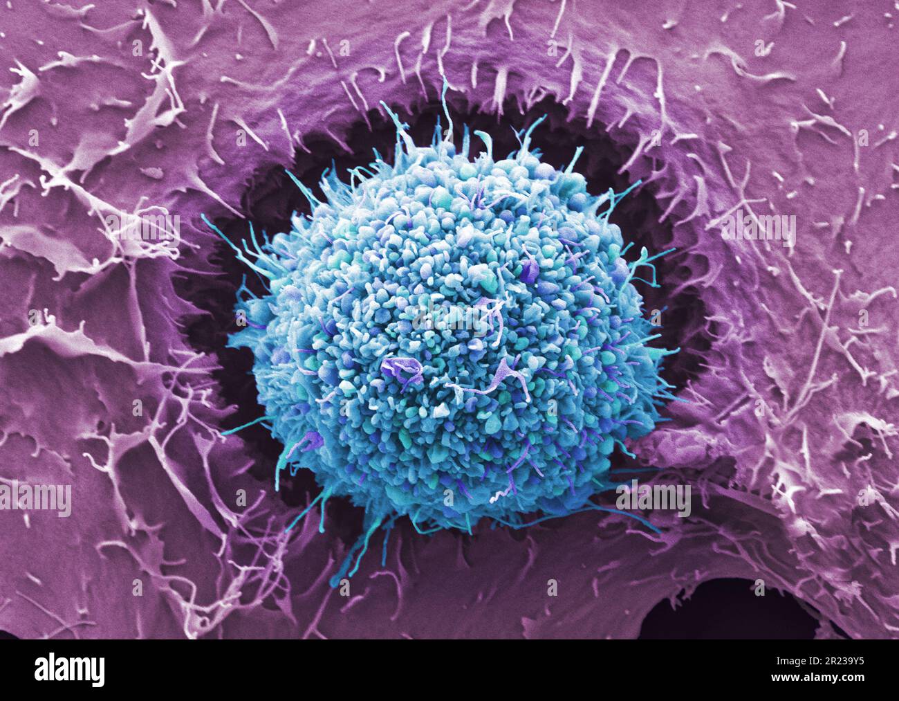 Cervical cancer cell, SEM Stock Photo - Alamy