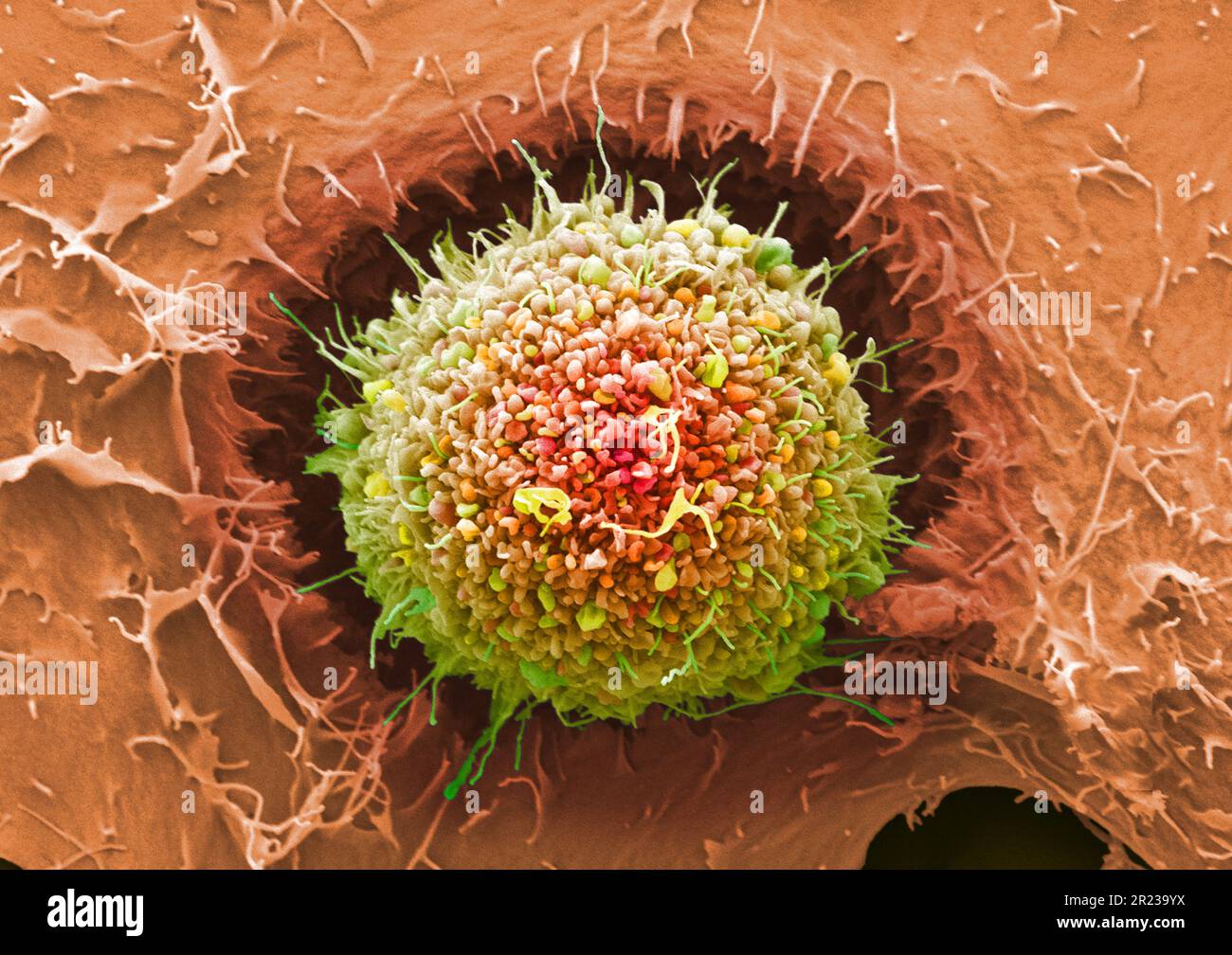 Cervical cancer cell, SEM Stock Photo - Alamy