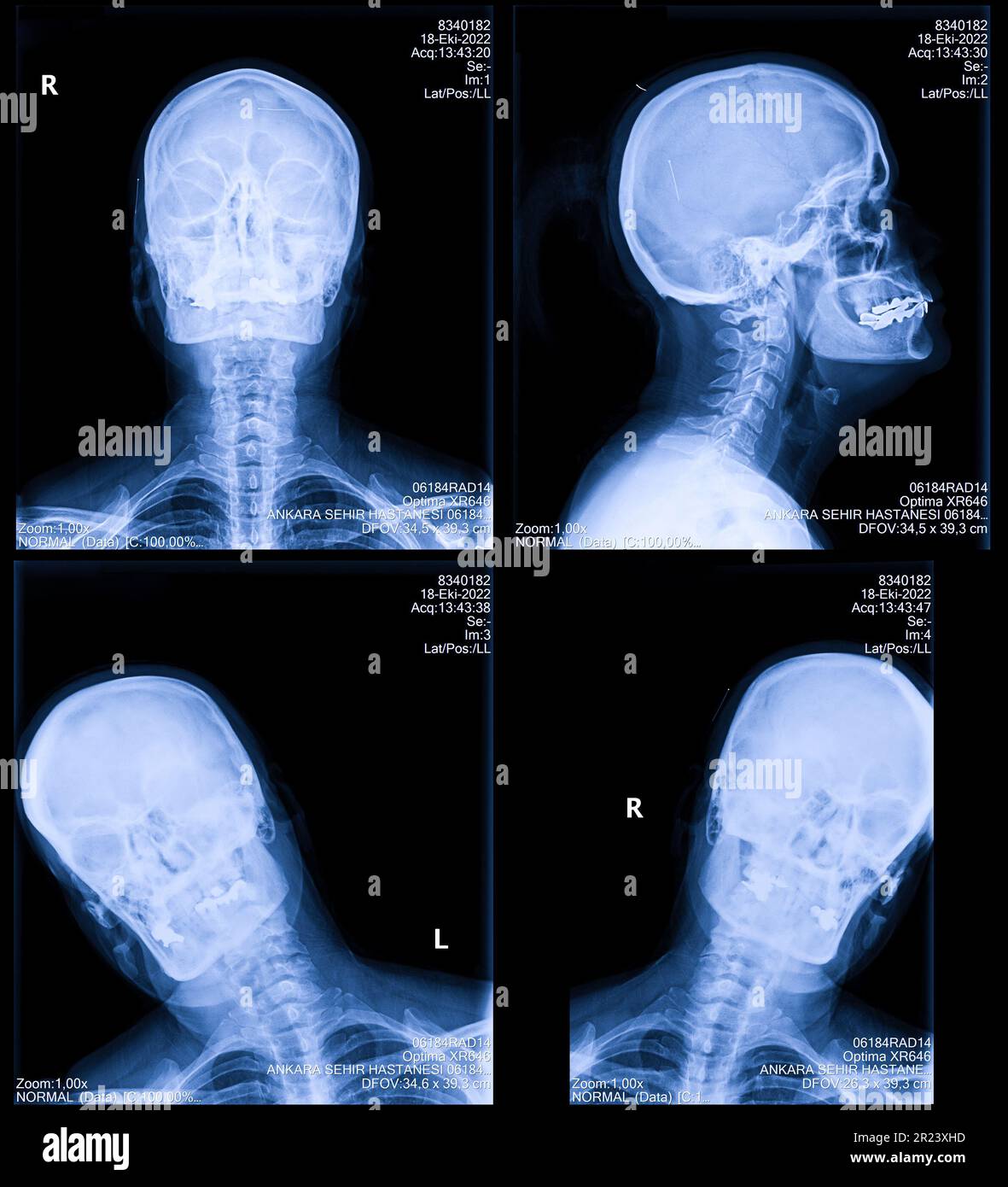 Cervical vertebrae cancer hi-res stock photography and images - Alamy