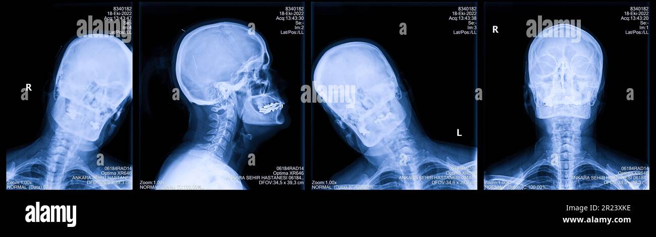 Human cervical spine x-ray, neck radiography Stock Photo - Alamy