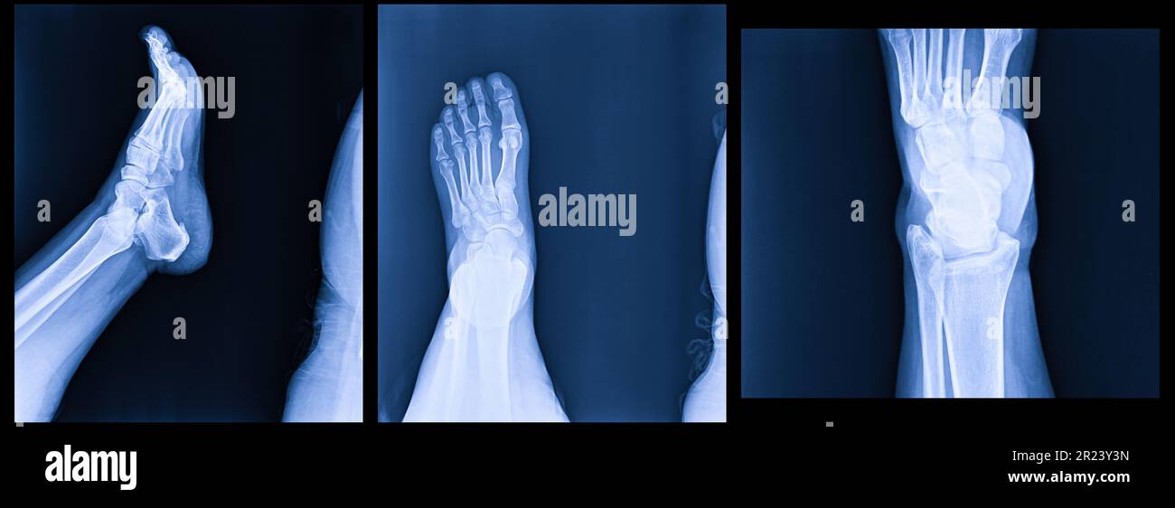 X-ray normal human's foot lateral Stock Photo - Alamy