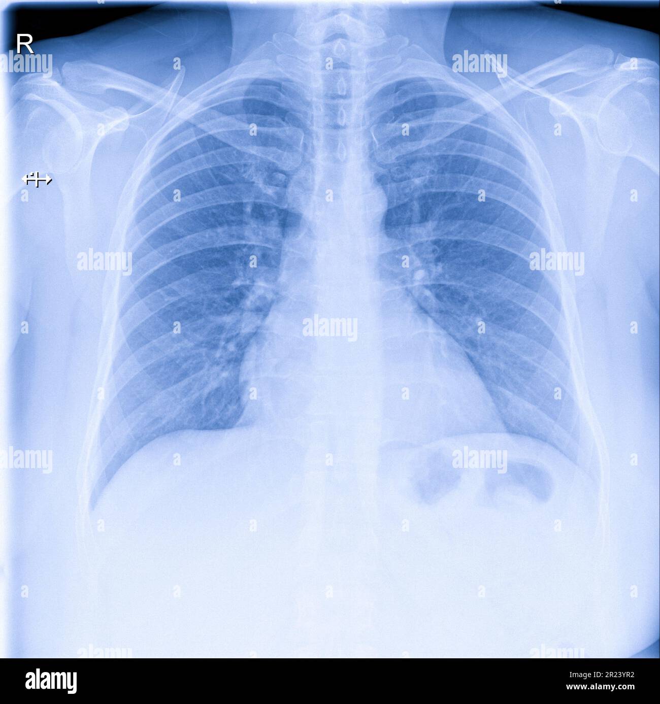 Human thorax x-ray for lungs examination, PA up right. Cancer infected ...