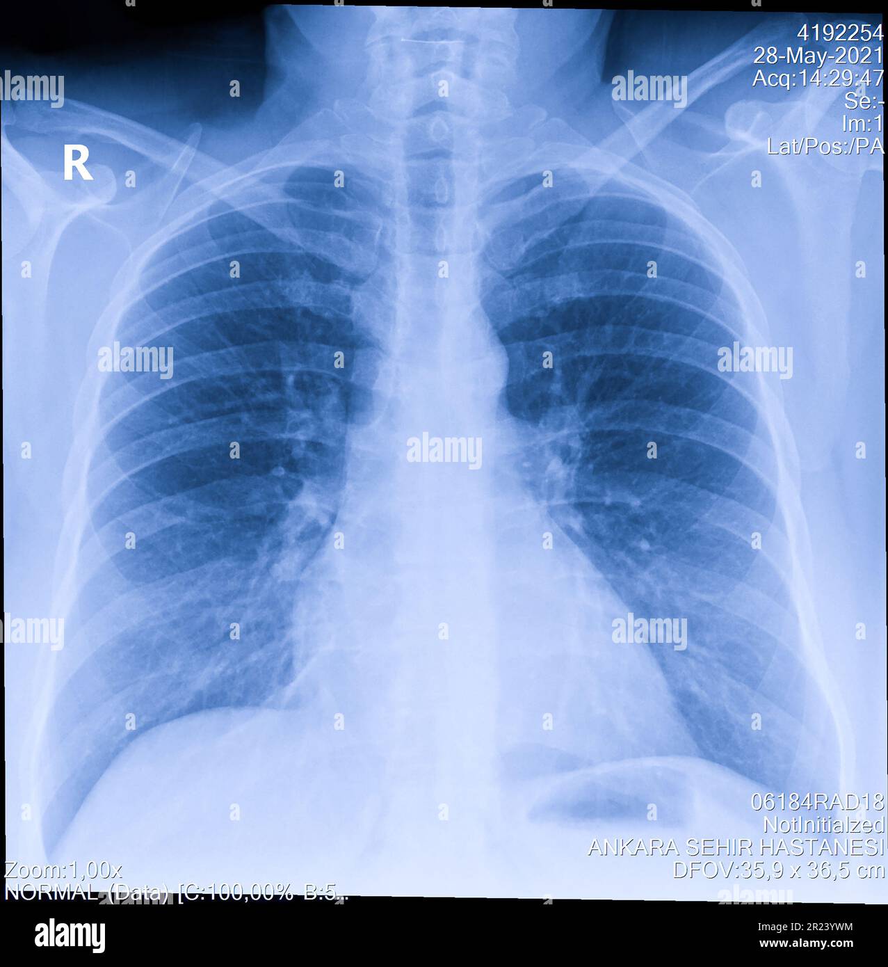 Human thorax x-ray for lungs examination, PA up right. Cancer infected ...