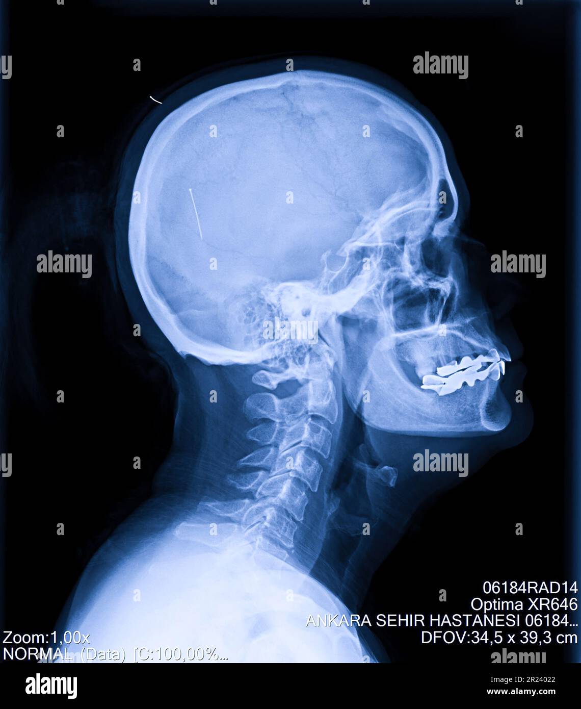 Woman's cervical spine x-ray, human neck radiography Stock Photo - Alamy