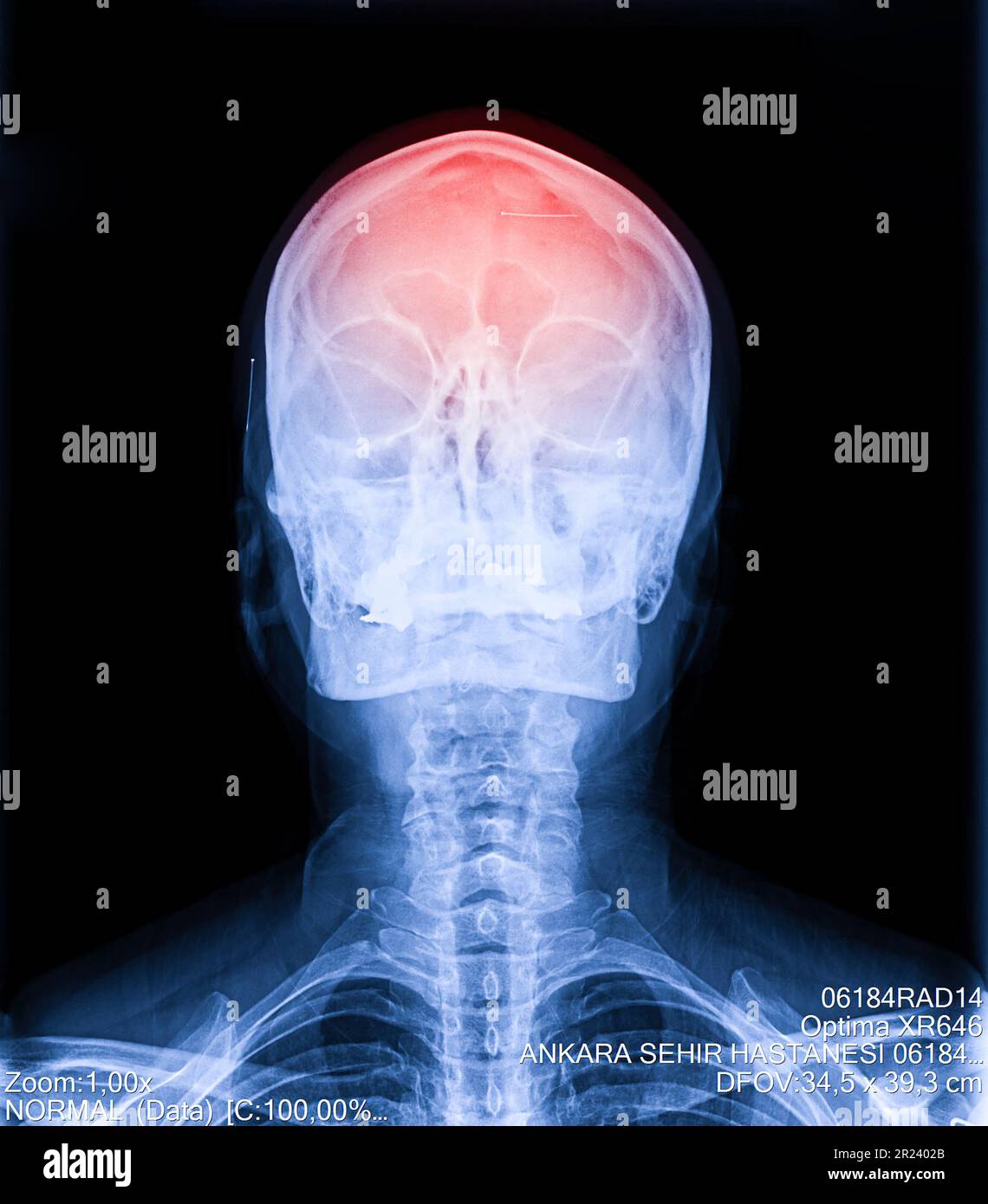Woman's cervical spine x-ray, headache Stock Photo - Alamy