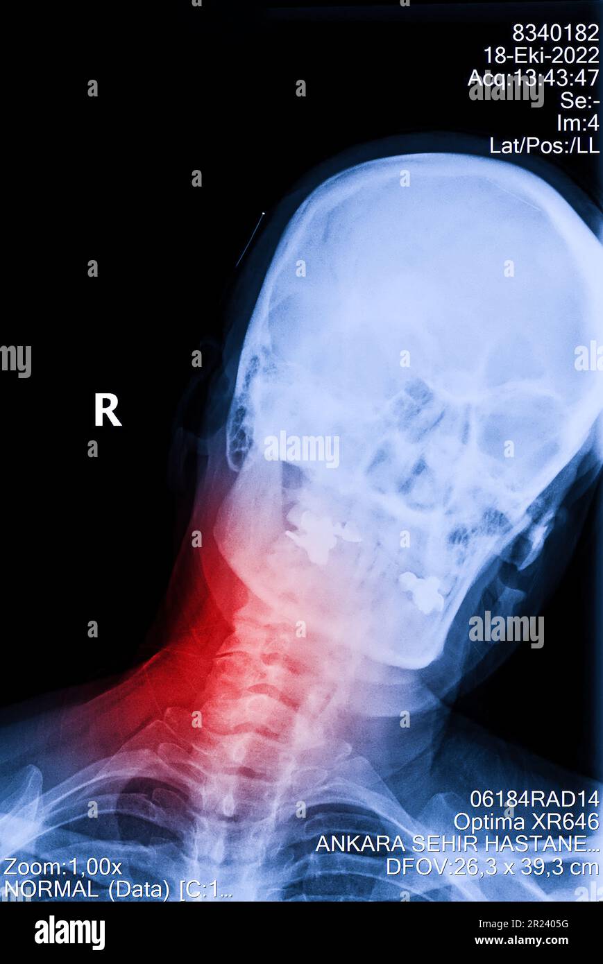 X-ray of neck and cervical spine view. Image of radiography from ...