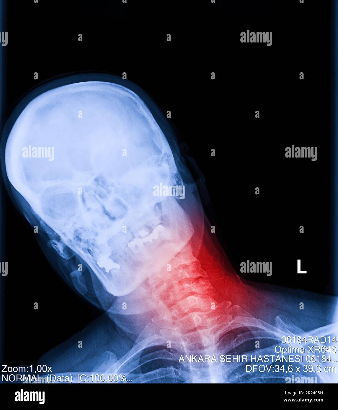 X-ray of neck and cervical spine view. Image of radiography from ...