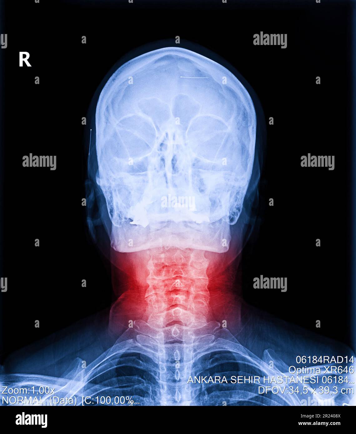 X-ray of neck and cervical spine view. Image of radiography from ...