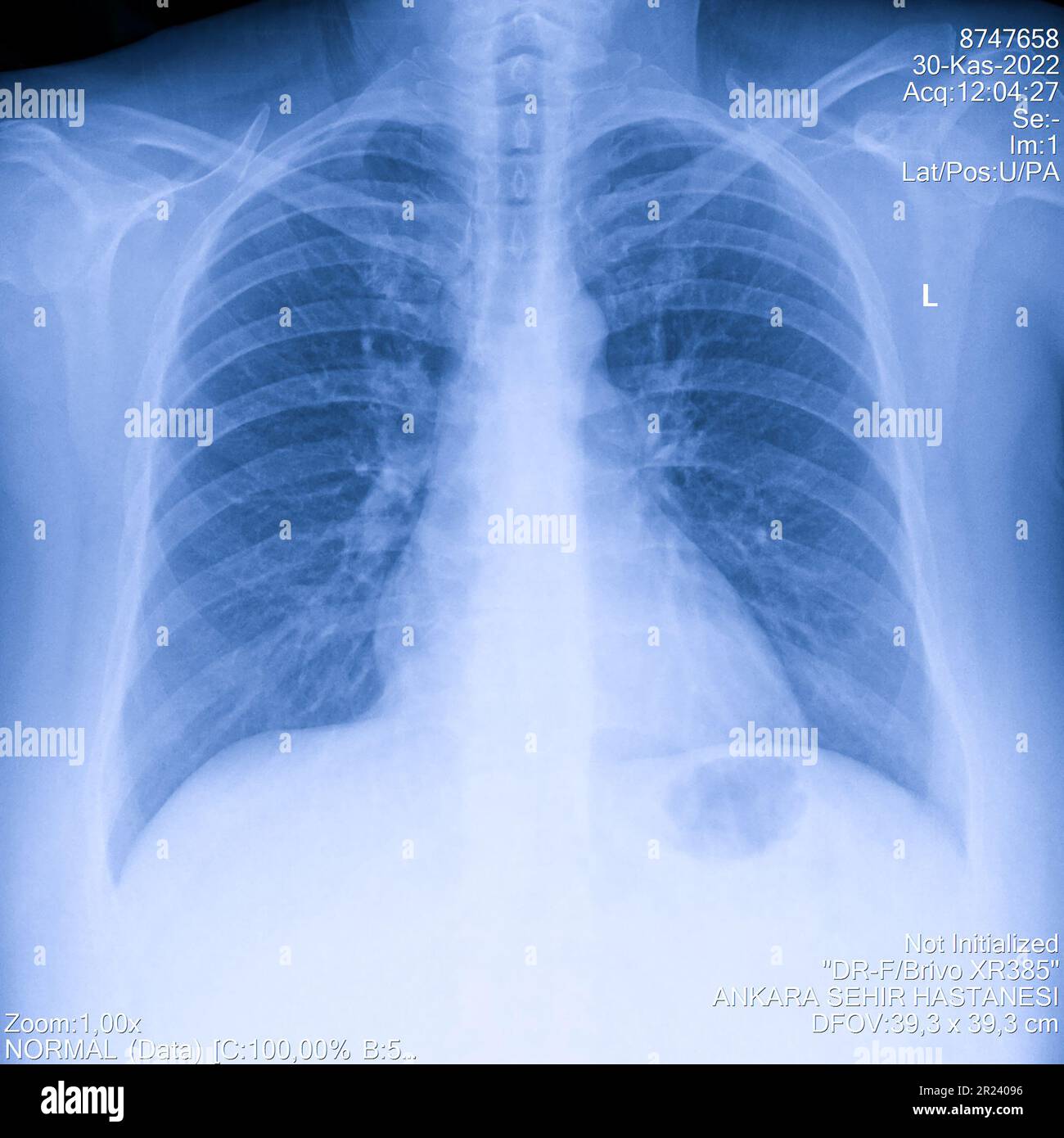 X-Ray Image Of Human Chest for a medical diagnosis Stock Photo - Alamy