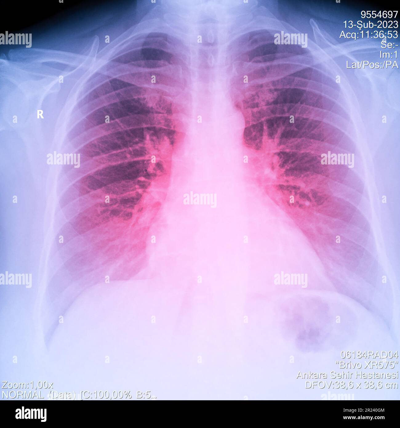X-Ray Image Of Human Chest for a medical diagnosis, shows pain area ...