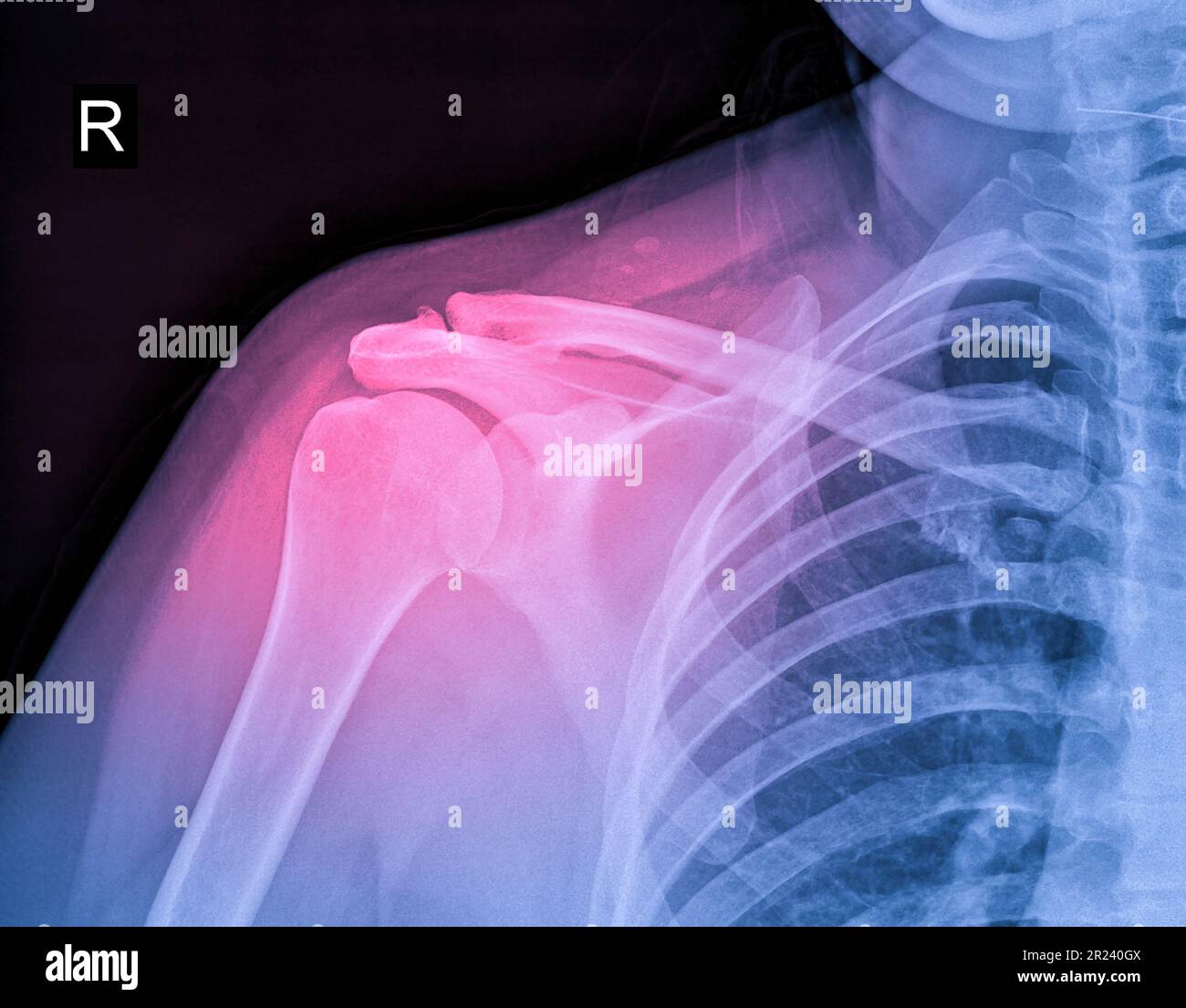 X-ray image of shoulder pain, shoulder ligament tendinitis, shoulder ...